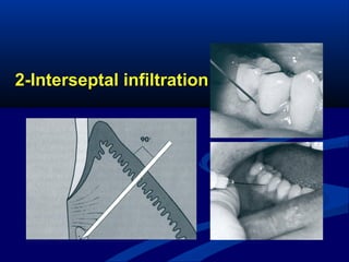 Mandibular Local Anesthesia | PPT