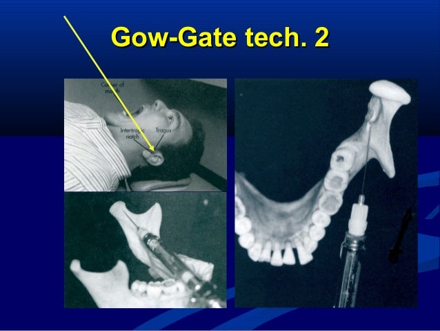 Dental Anesthesia Gowgates Mandibular Nerve Block An Gow Gates.flv