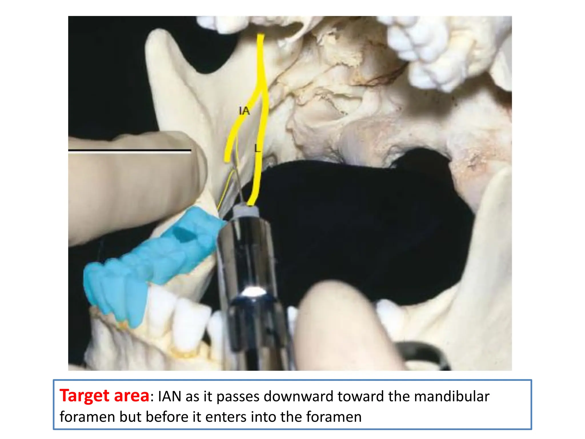 mandibular techniques in your area are here | PDF