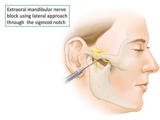 mandibular techniques in your area are here | PDF