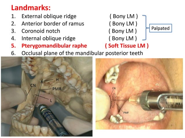 mandibular techniques in your area are here | PDF