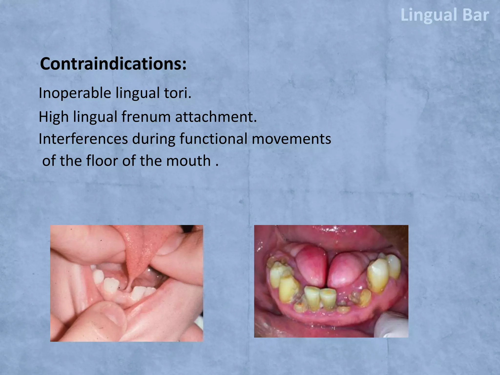 Mandibular Major Connectors | PPTX
