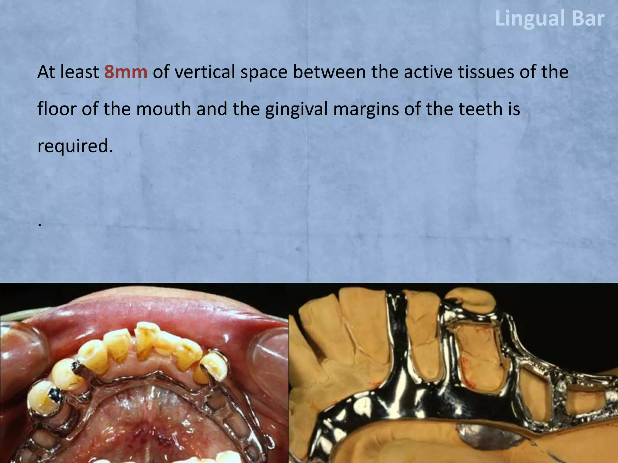 Mandibular Major Connectors | PPTX