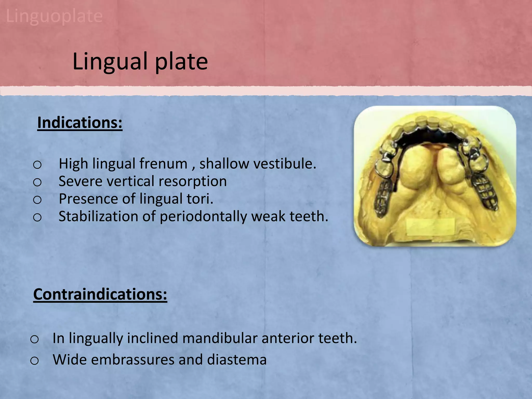 Mandibular Major Connectors | PPTX