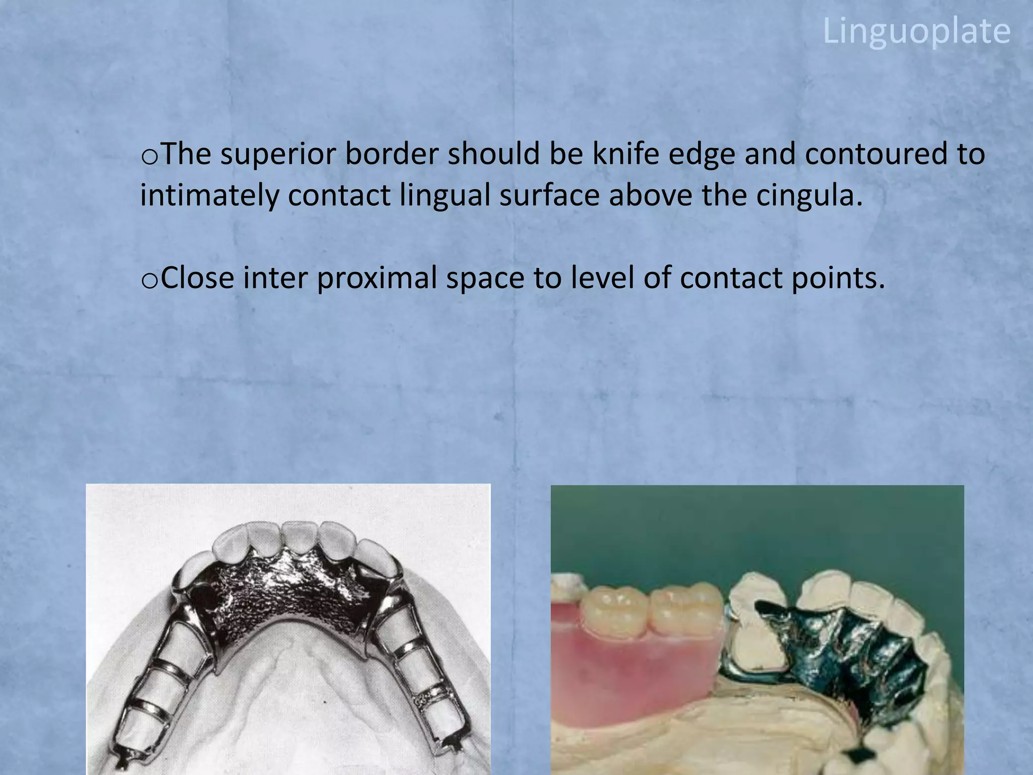 Mandibular Major Connectors | PPTX