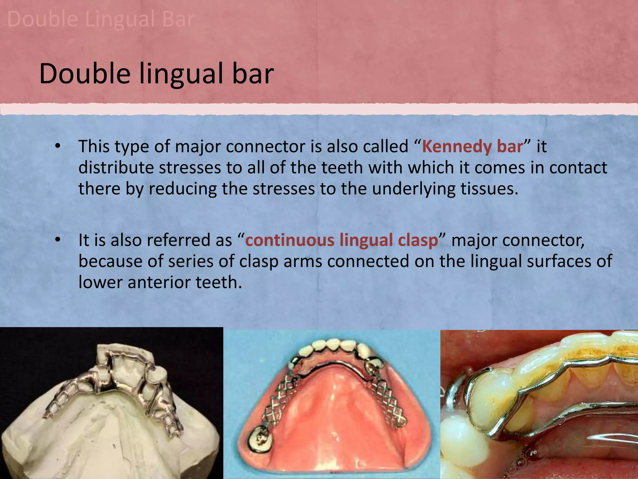 Mandibular Major Connectors | PPTX