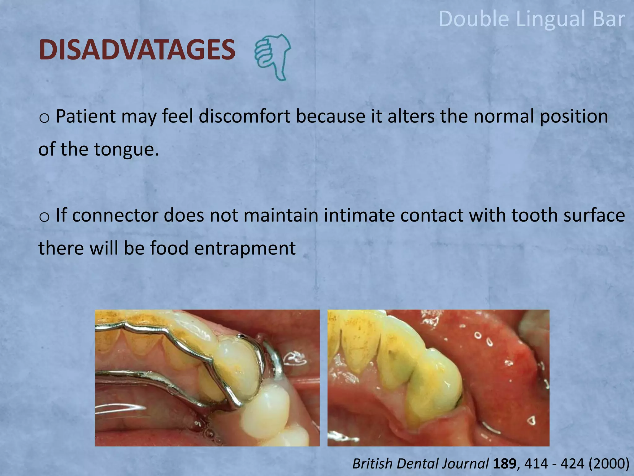 Mandibular Major Connectors | PPTX