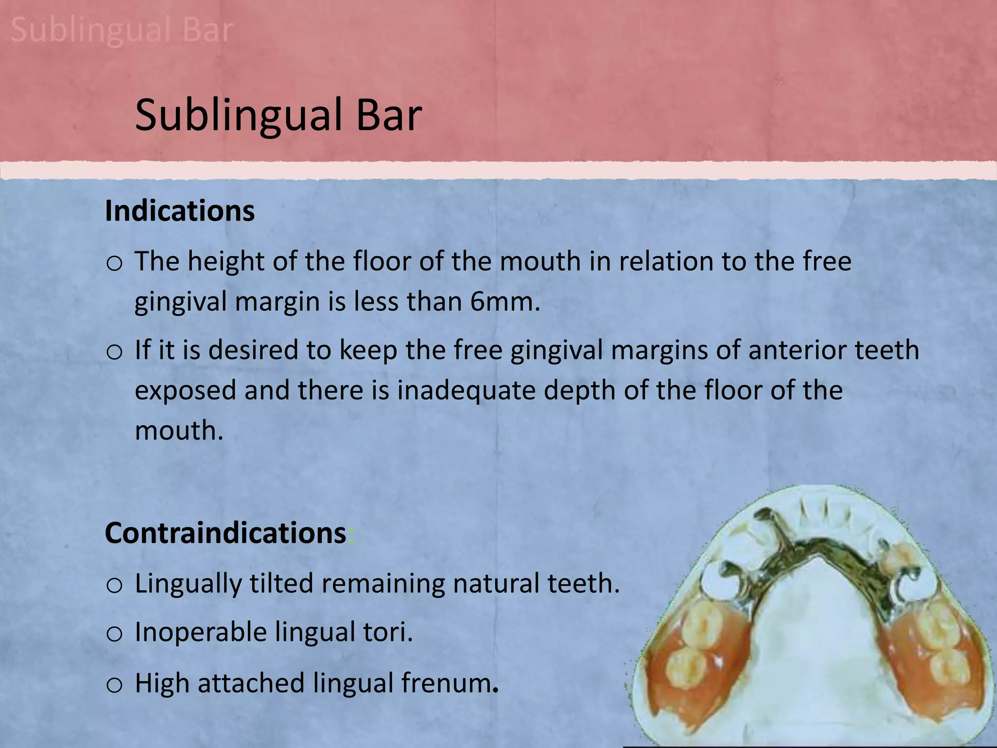 Mandibular Major Connectors | PPTX