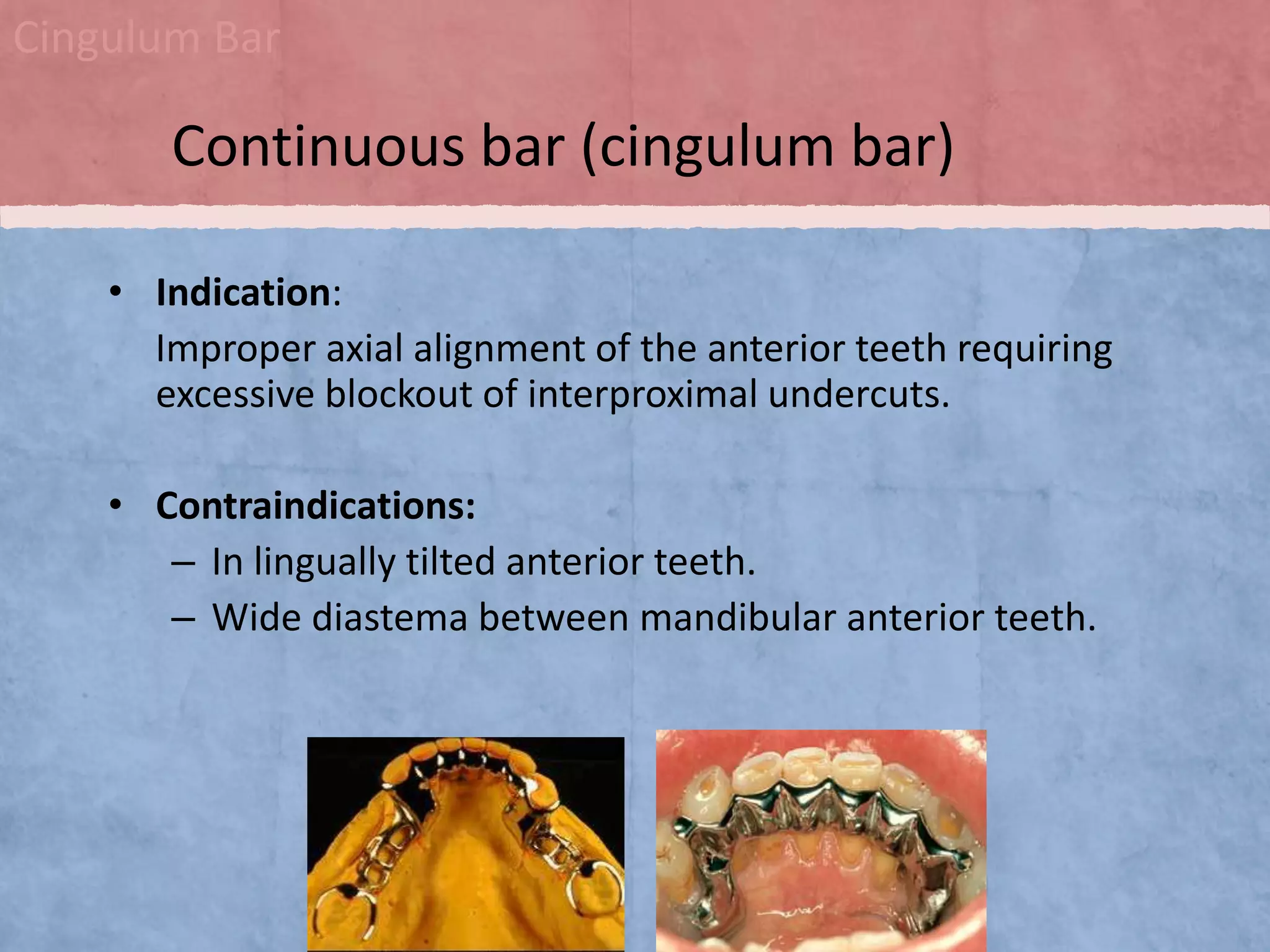 Mandibular Major Connectors | PPTX