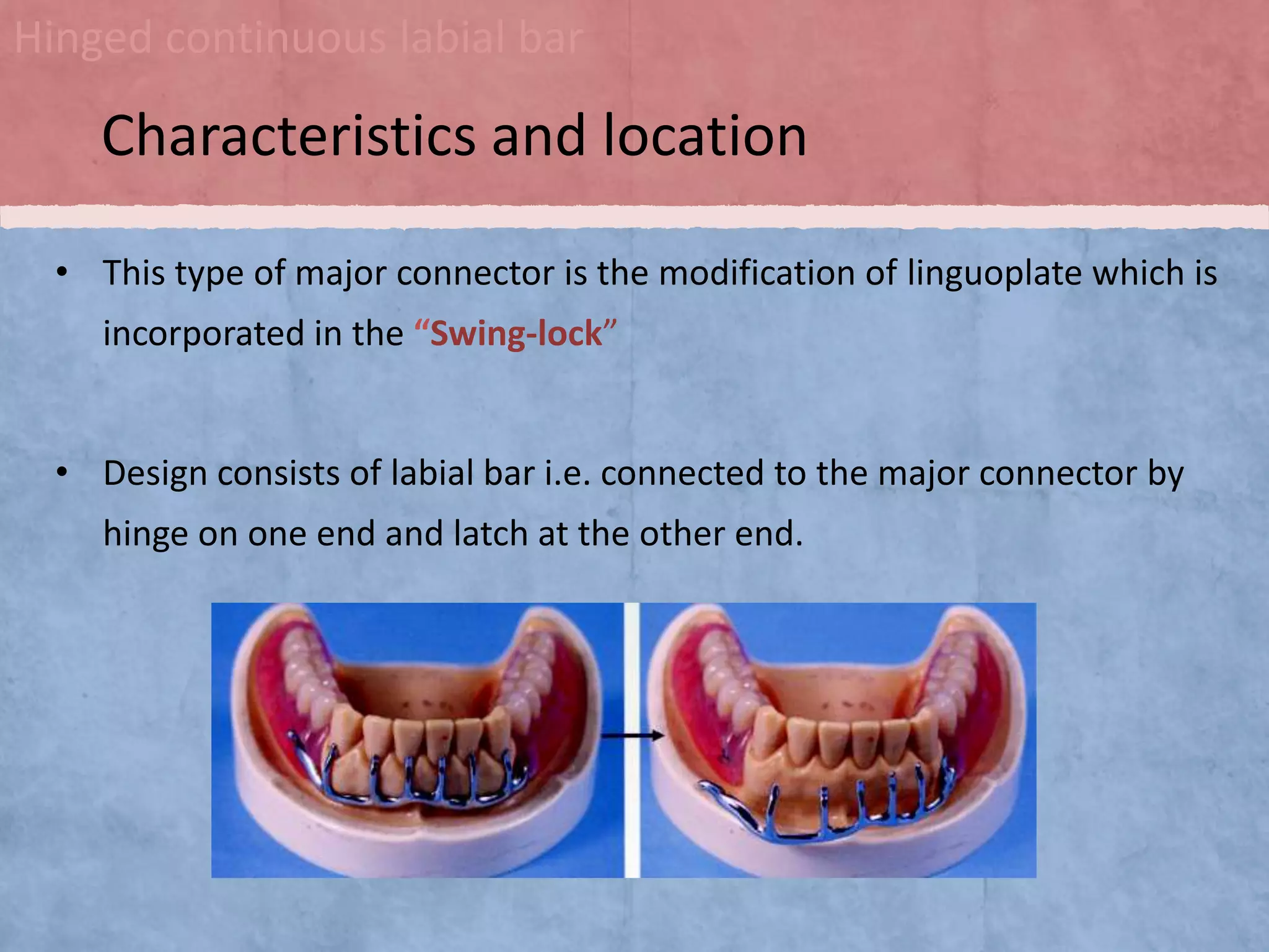 Mandibular Major Connectors | PPTX