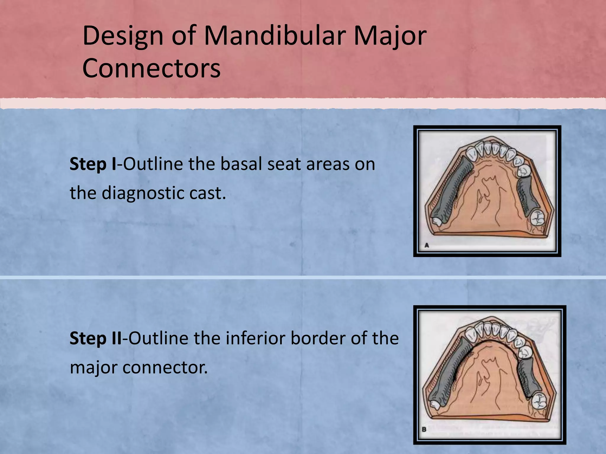 Mandibular Major Connectors | PPTX | Dental Health | Diseases and Conditions