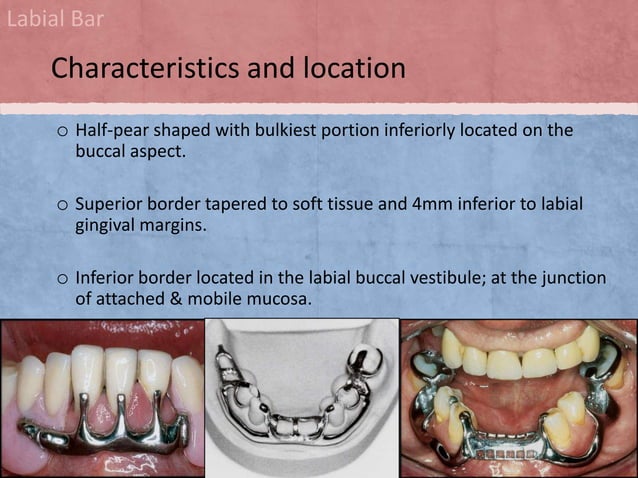 Mandibular Major Connectors | PPTX | Dental Health | Diseases and ...