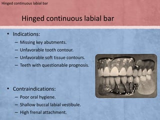 Mandibular Major Connectors | PPTX