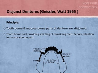 Mandibular Major Connectors | PPTX
