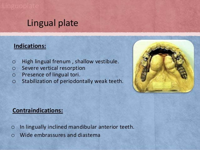 Mandibular Major Connectors