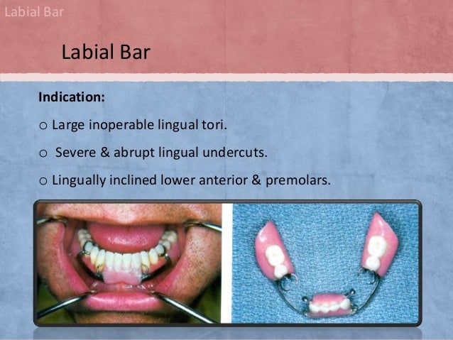 Mandibular Major Connectors