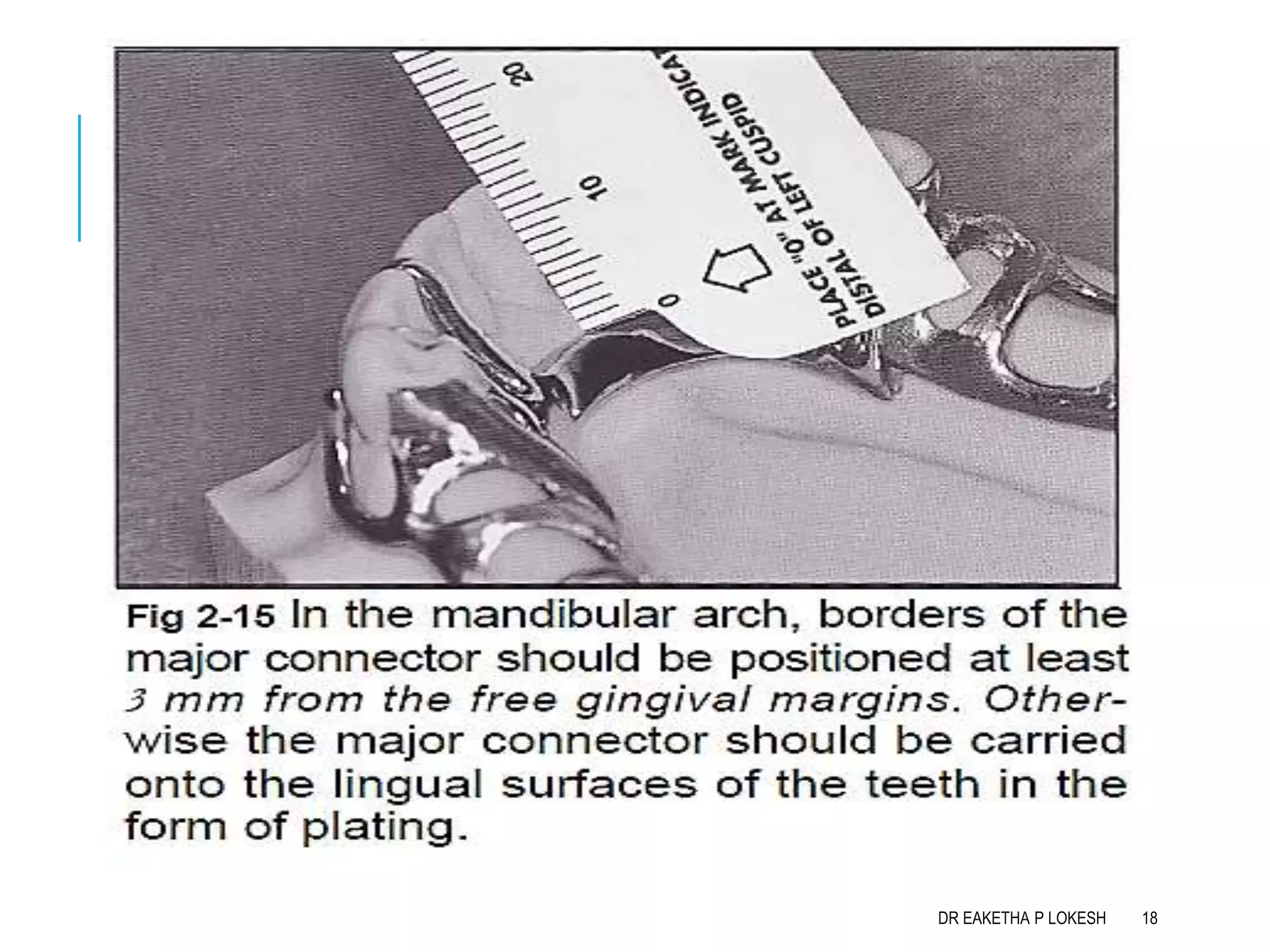 Mandibular major connectors | PPTX | Dental Health | Diseases and Conditions
