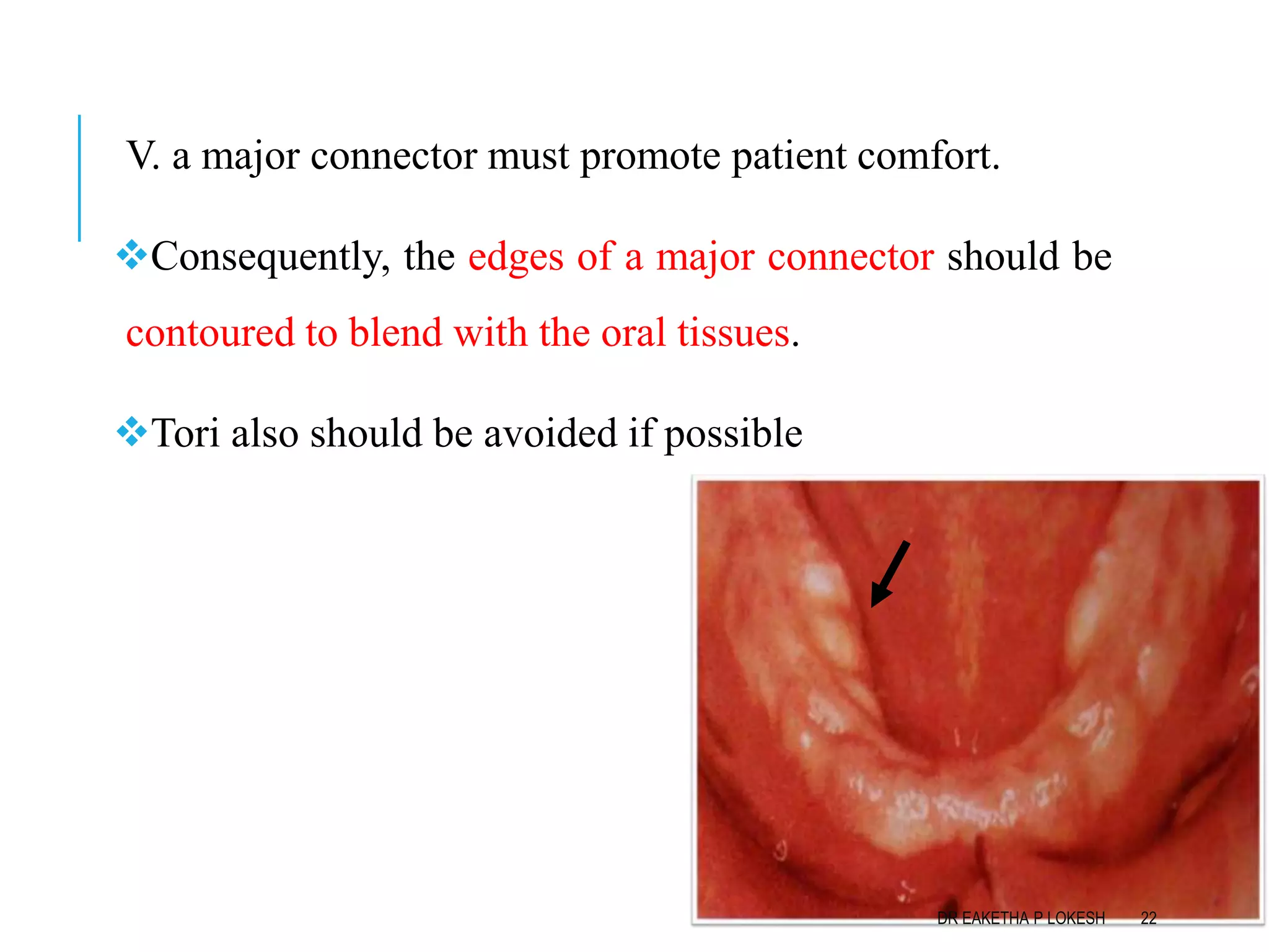 Mandibular major connectors | PPTX | Dental Health | Diseases and Conditions
