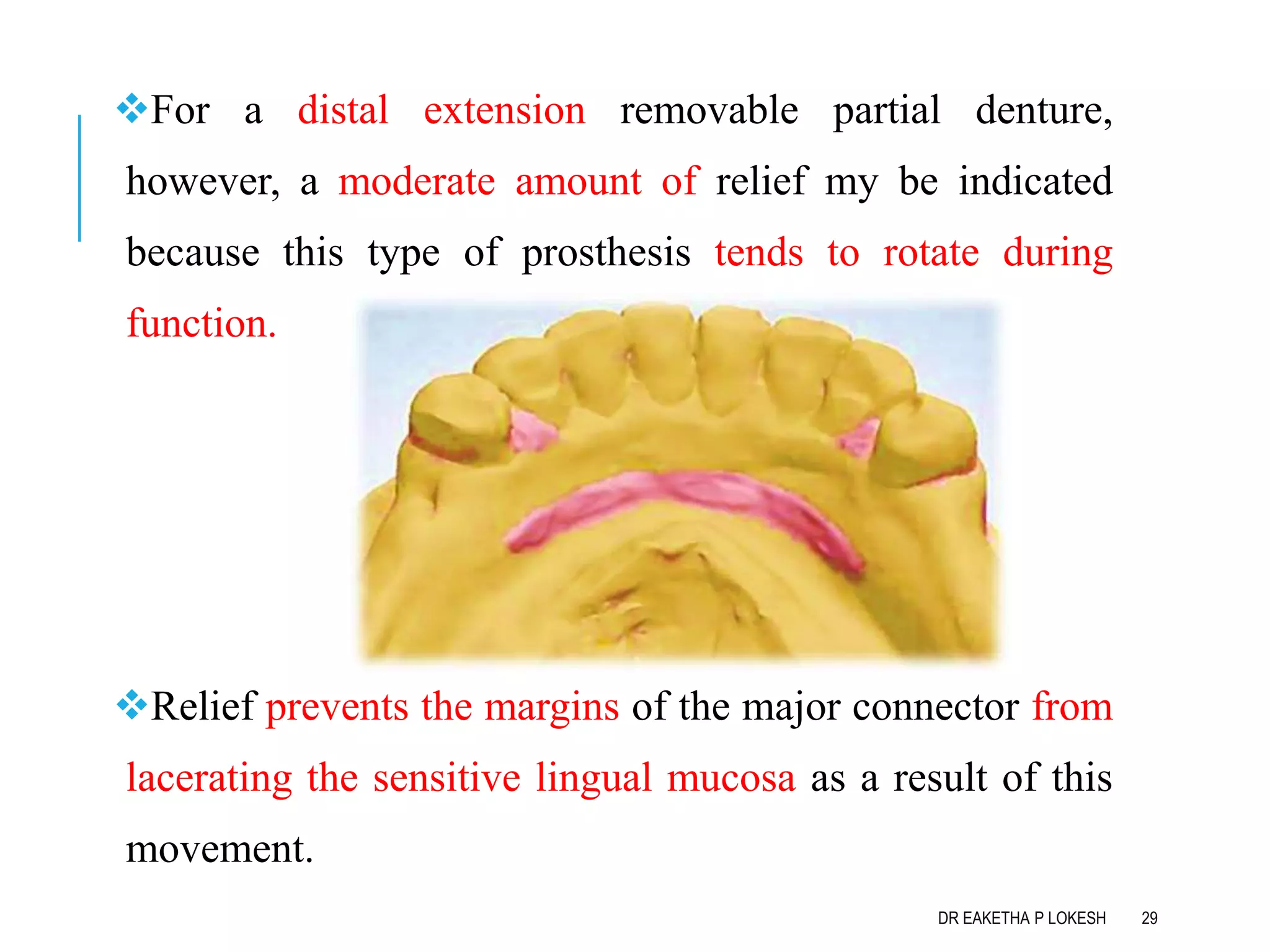 Mandibular major connectors | PPTX