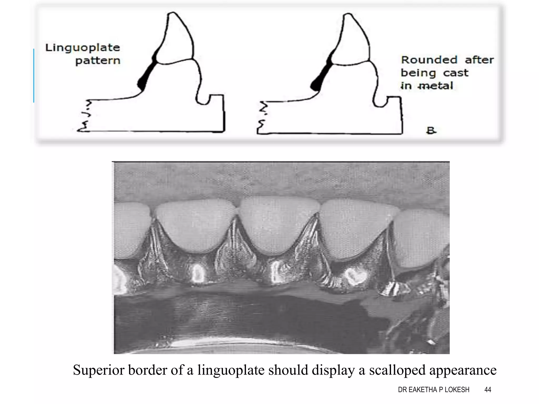Mandibular major connectors | PPTX