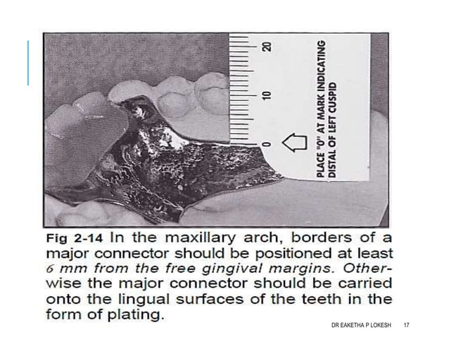 Mandibular major connectors | PPTX | Dental Health | Diseases and ...