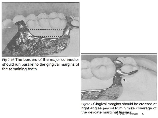 Mandibular major connectors | PPTX | Dental Health | Diseases and ...