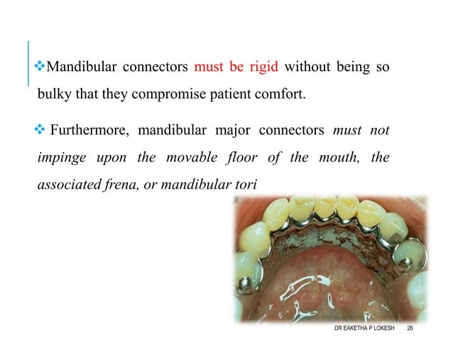 Mandibular major connectors | PPTX | Dental Health | Diseases and Conditions