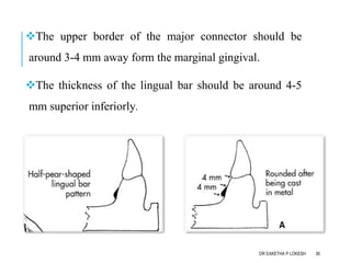 Mandibular major connectors | PPTX