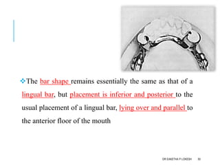 Mandibular major connectors | PPTX