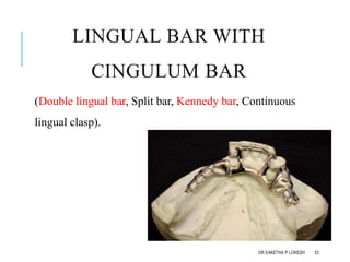 Mandibular major connectors | PPTX