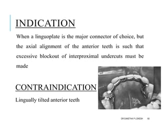 Mandibular major connectors | PPTX