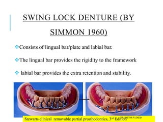 Mandibular major connectors | PPTX