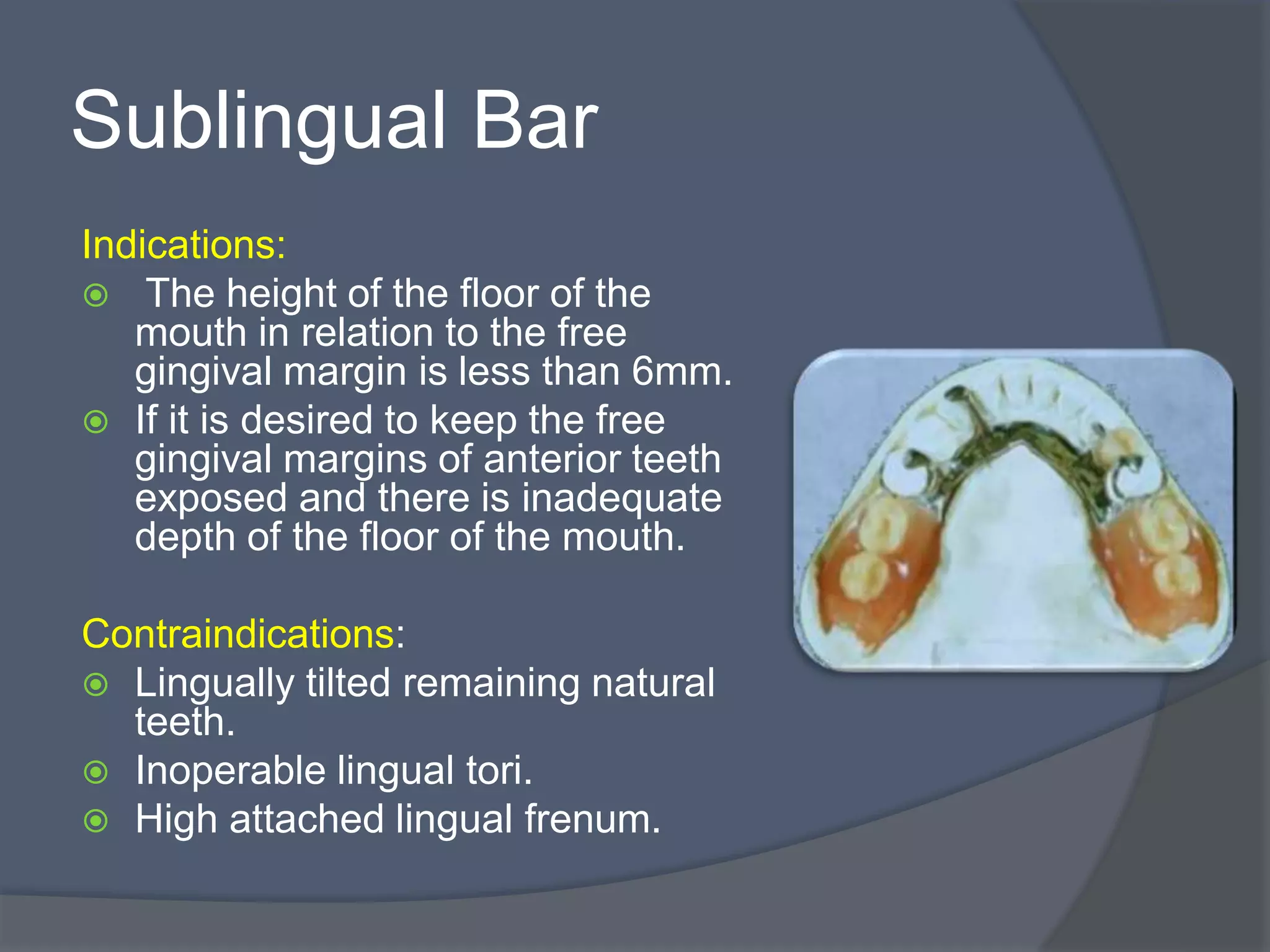 Mandibular Major Connectors | PPTX