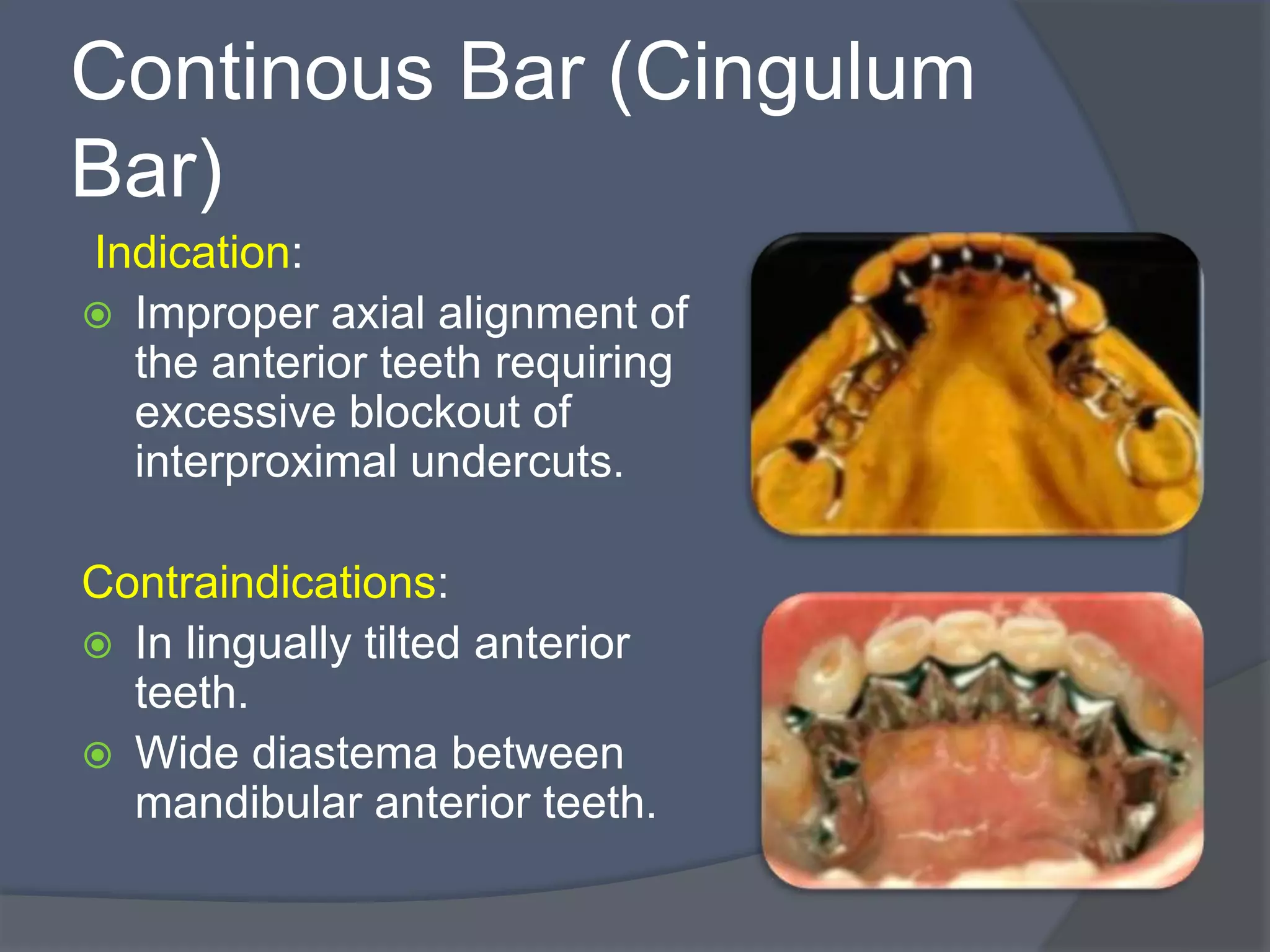 Mandibular Major Connectors | PPTX