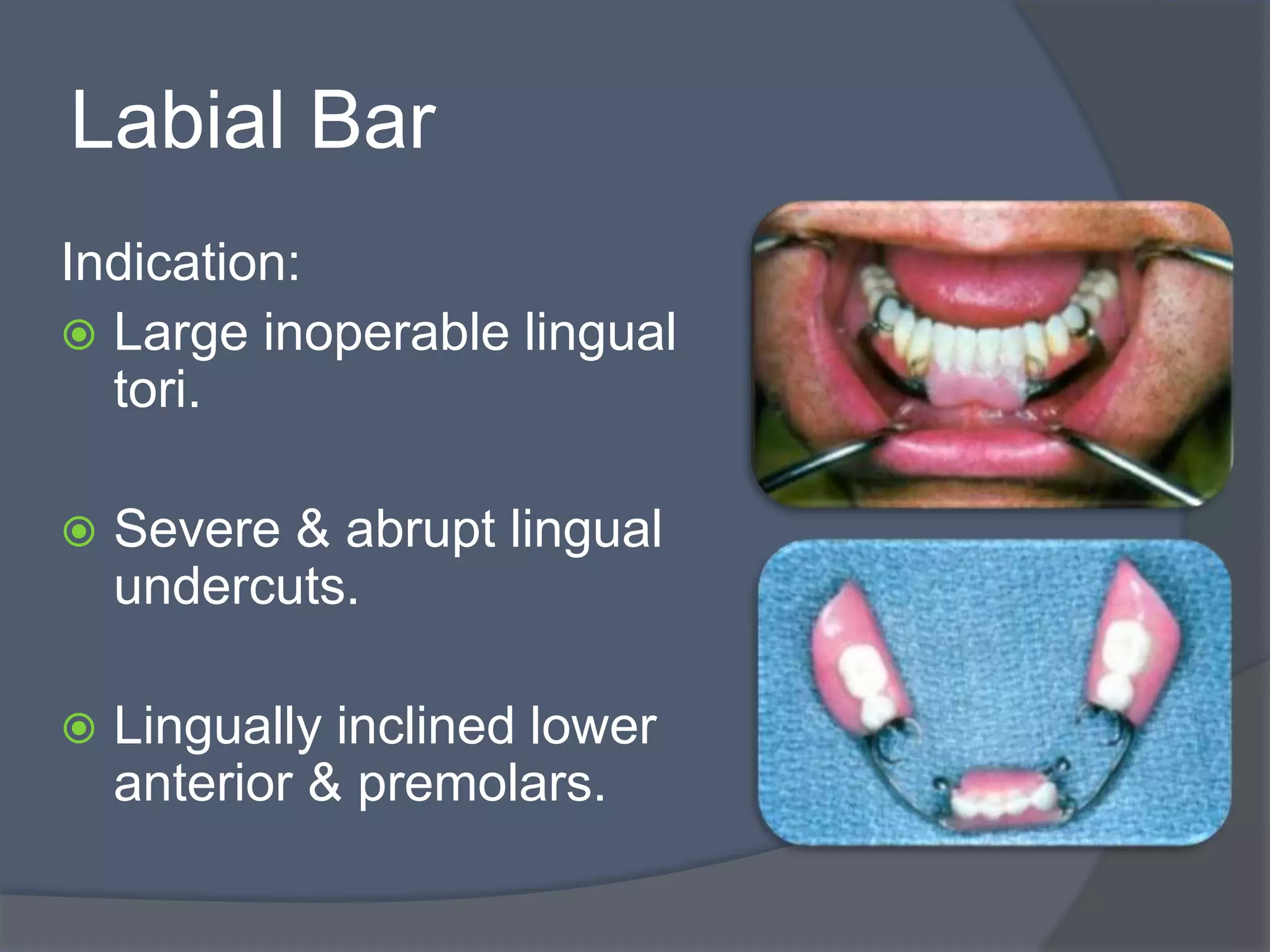 Mandibular Major Connectors | PPTX