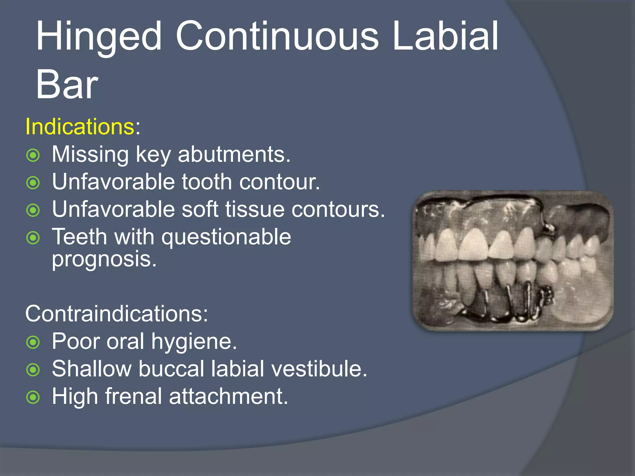 Mandibular Major Connectors | PPTX