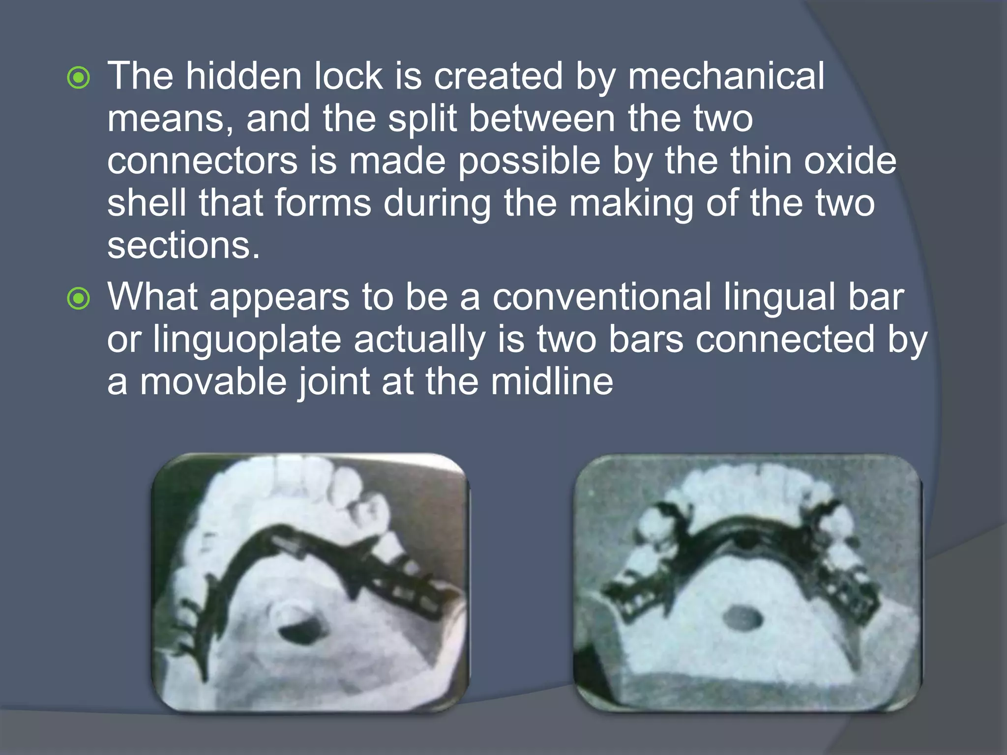 Mandibular Major Connectors | PPTX