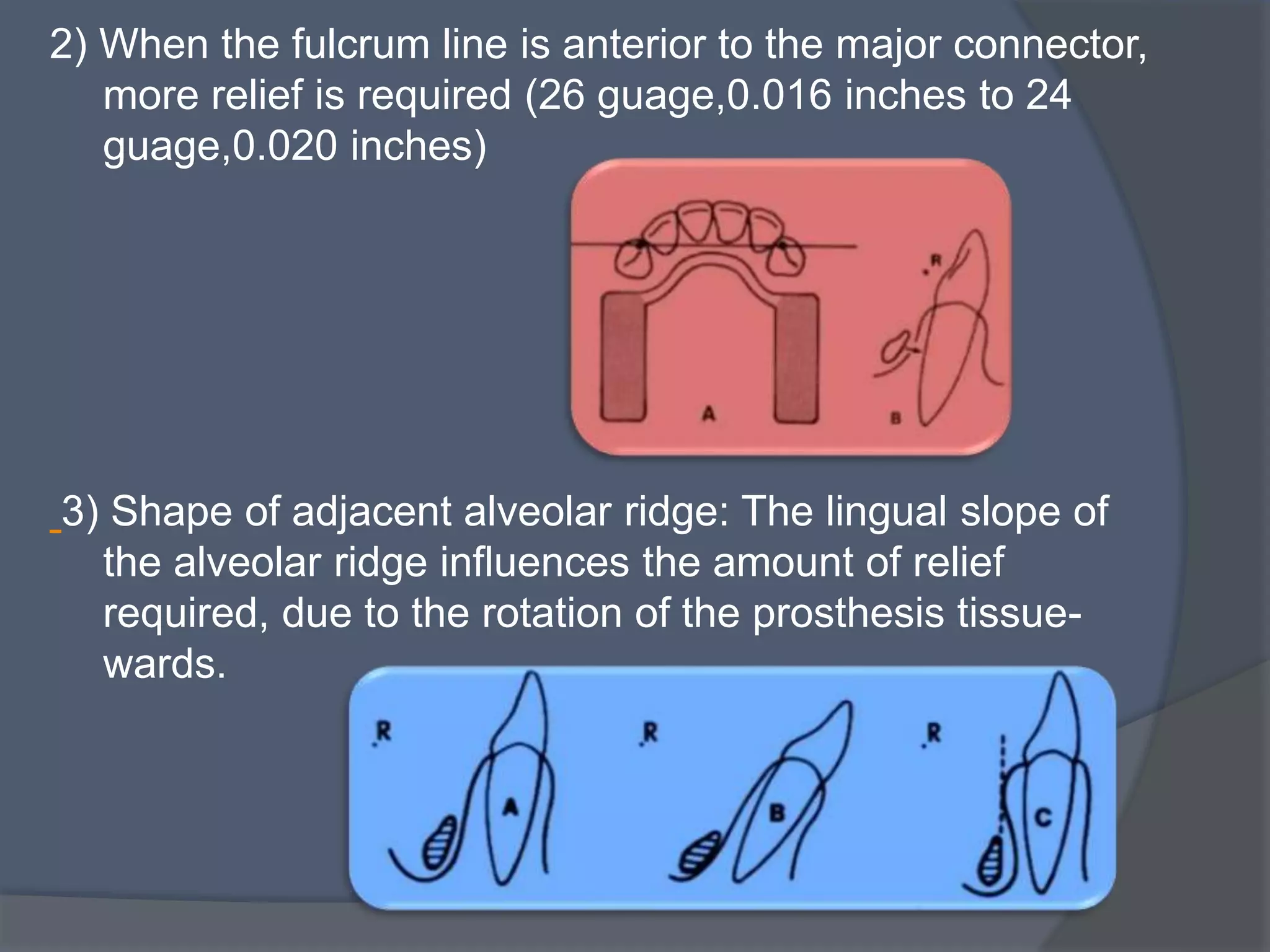 Mandibular Major Connectors | PPTX
