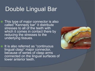 Mandibular Major Connectors | PPTX