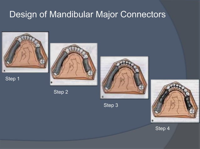 Mandibular Major Connectors | PPTX