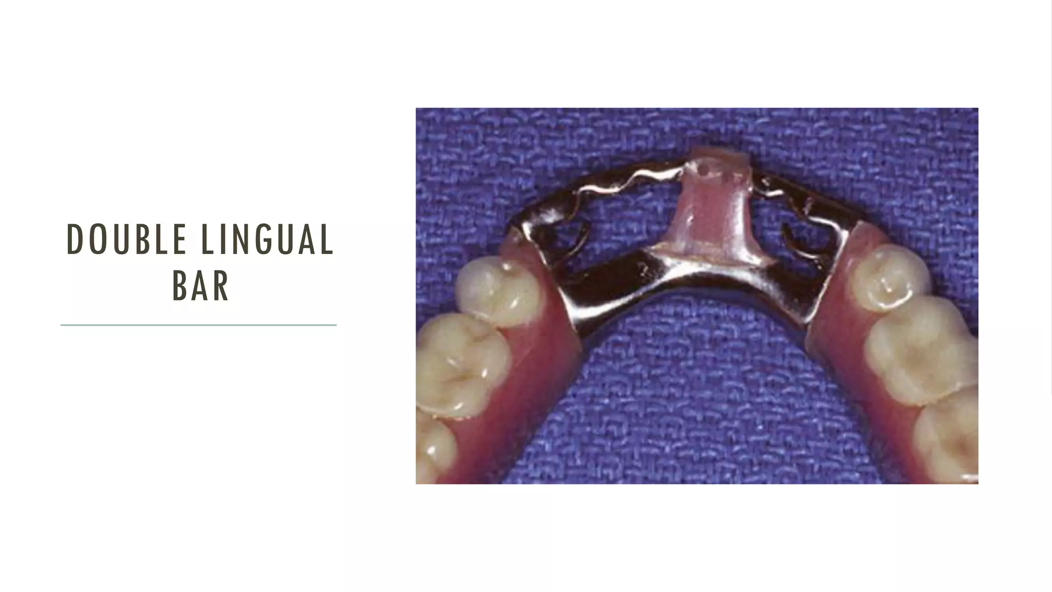 Mandibular Major Connectors | PDF
