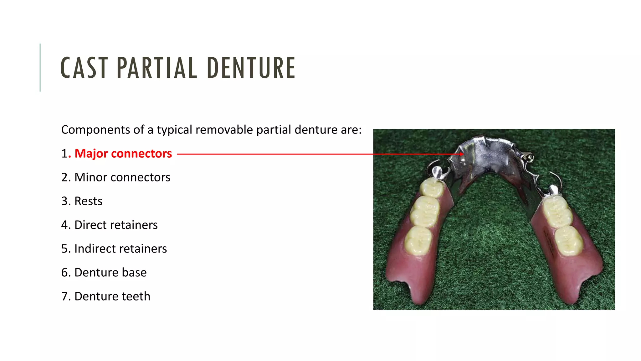 Mandibular Major Connectors | PDF