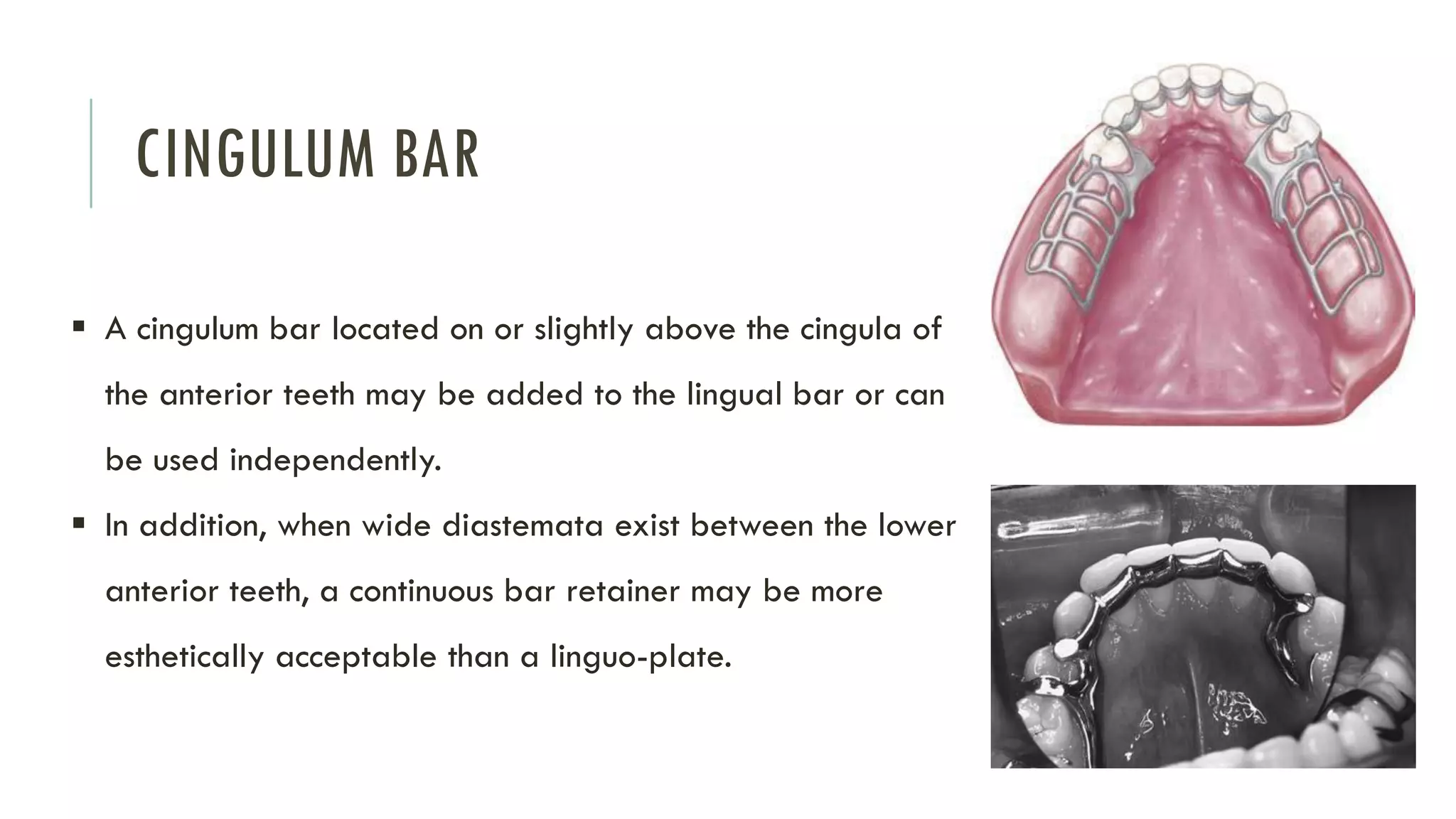 Mandibular Major Connectors | PDF