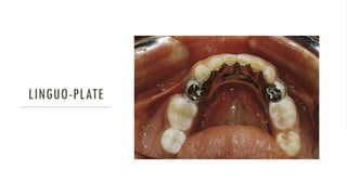 Mandibular Major Connectors | PDF
