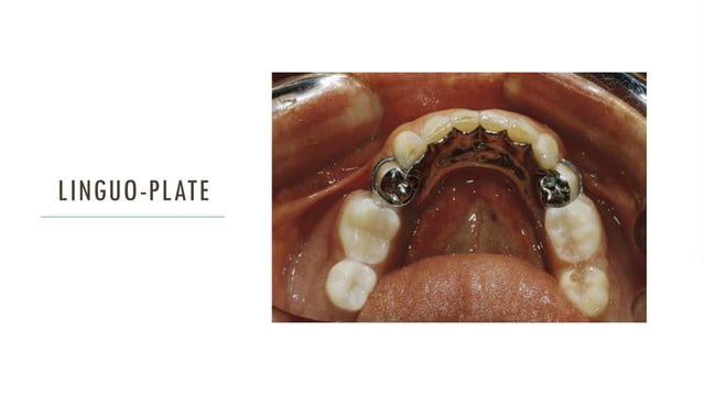 Mandibular Major Connectors | PDF | Dental Health | Diseases and Conditions
