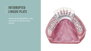 Mandibular Major Connectors | PDF
