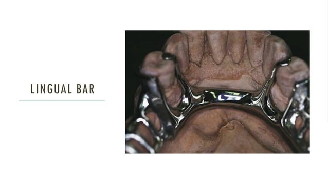 Mandibular Major Connectors | PDF | Dental Health | Diseases and Conditions