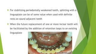 Mandibular Major Connectors Powerpoint Presentation | PPTX