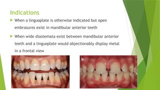 Mandibular Major Connectors Powerpoint Presentation | PPTX