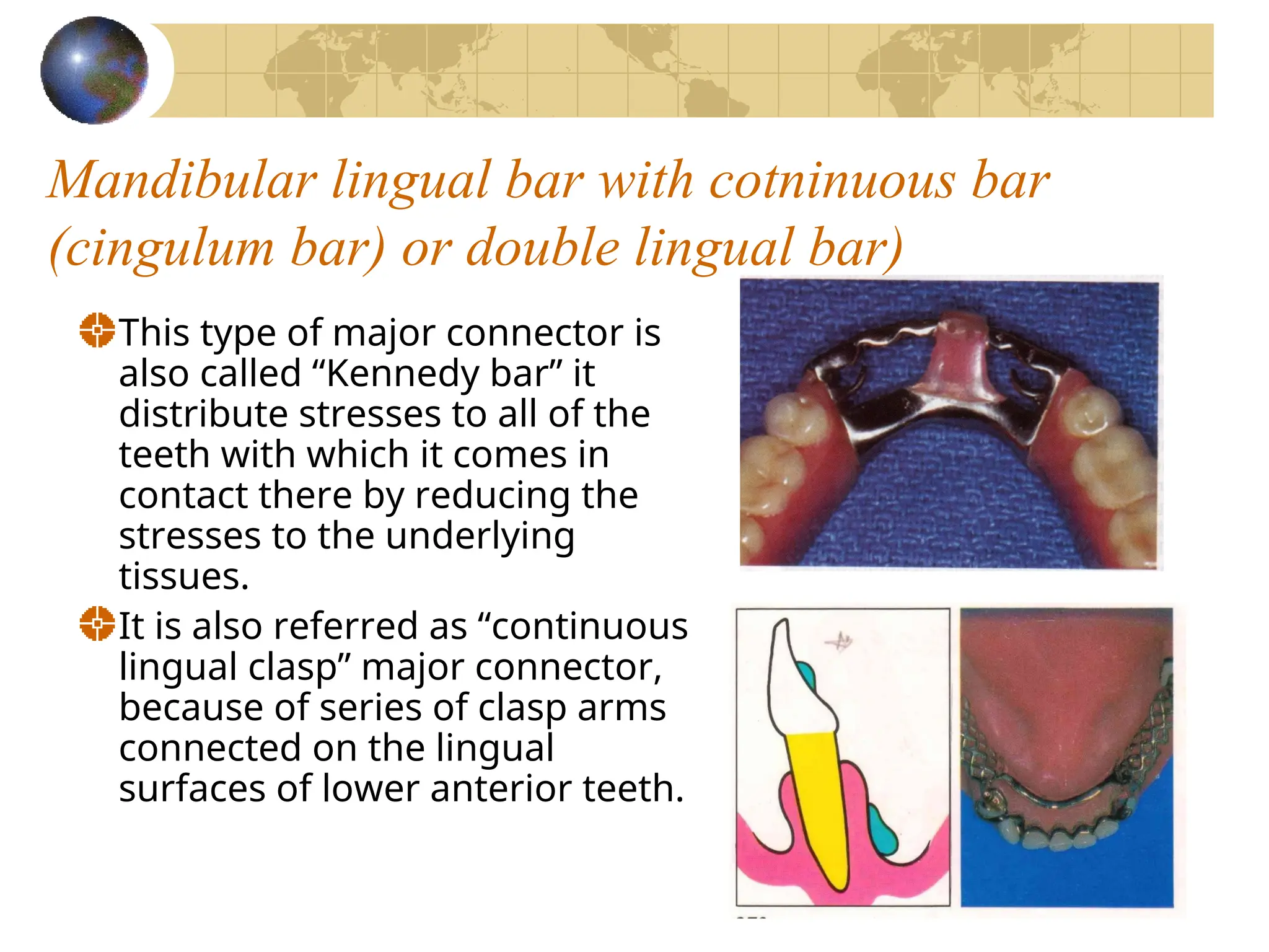Mandibular Major Connectors1.ppt